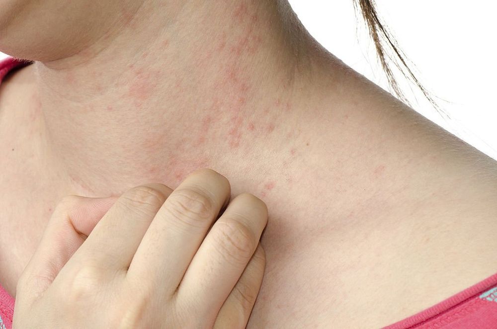 Scabies vs Eczema: Differences, Causes, and Treatment