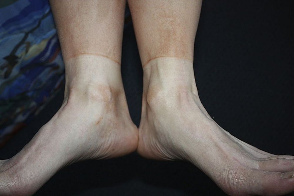What Causes Hyperpigmentation On Toes?