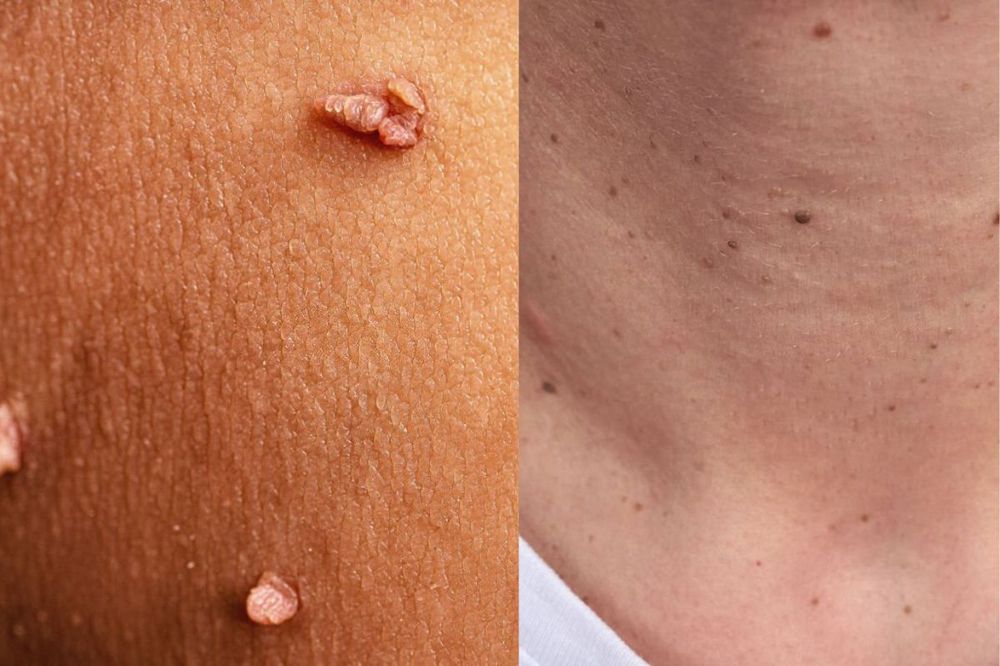Skin Tag Cancer: Causes, Symptoms & Treatment Options