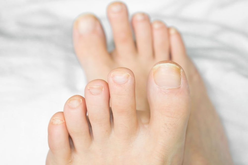 How to Know If Toenail Fungus Is Dying: 5 Signs of Recovering