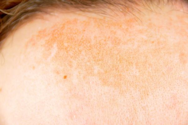 Sunspots on Skin: Causes, Symptoms, Treatment & Prevention